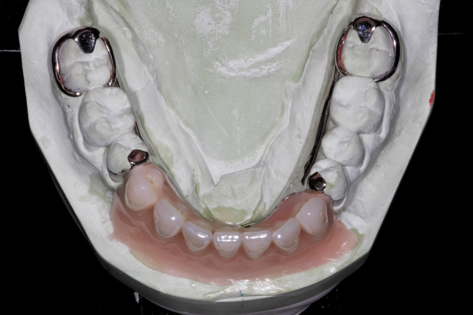 Boise Idaho Prosthodontics: True Immediate Maxillary Complete Denture ...