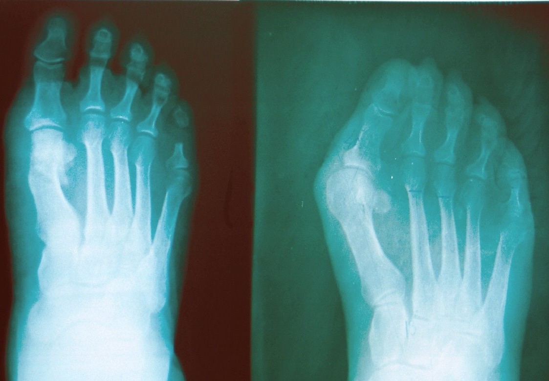 Podo Basas al Día: Austin con aguja reabsorbible. Hallux valgus con ...