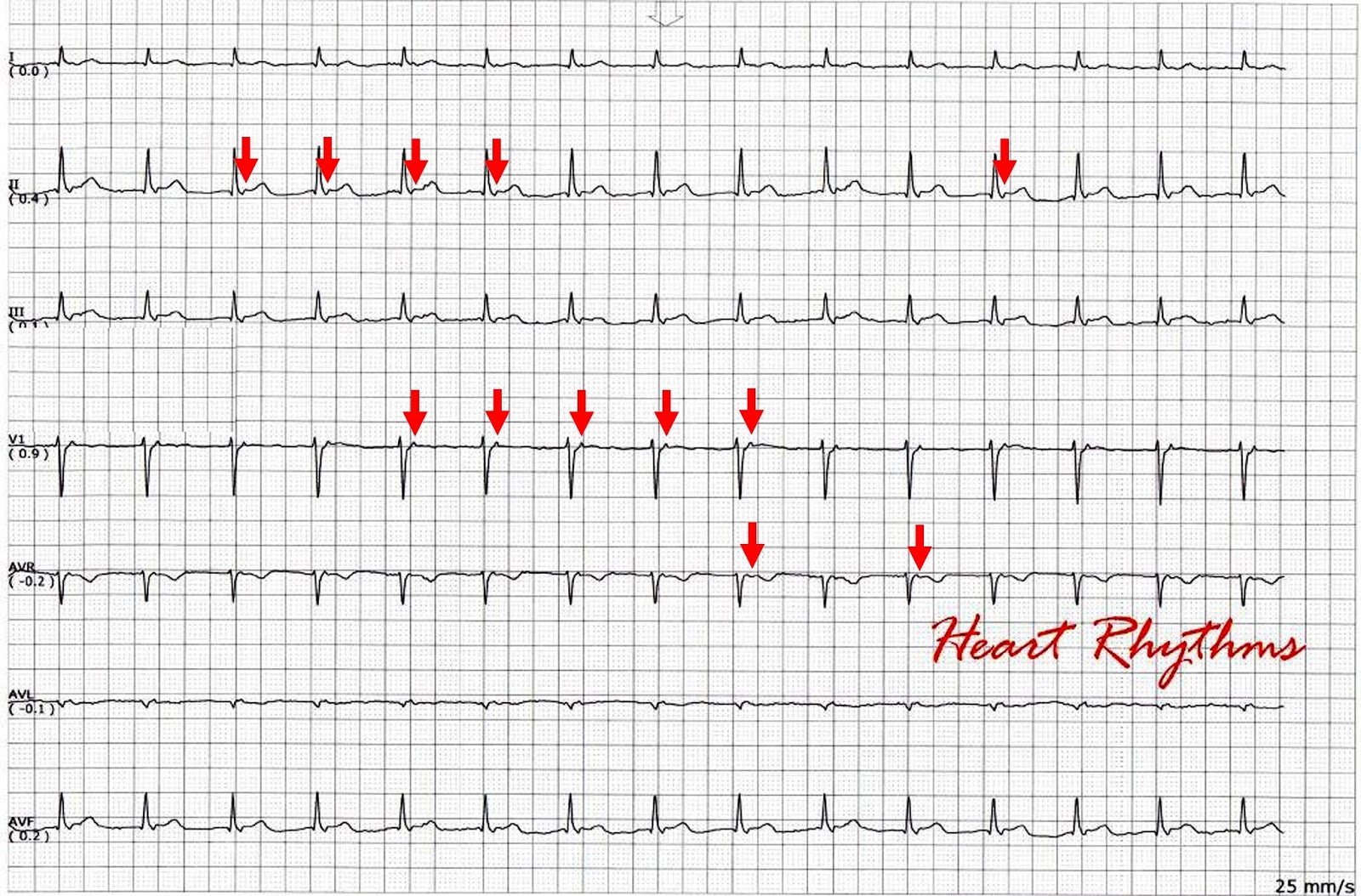 ECG Rhythms: Isorhythmic AV dissociation
