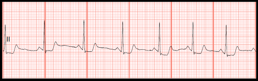 Practice EKG Strips