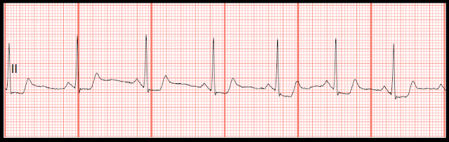 Practice EKG Strips