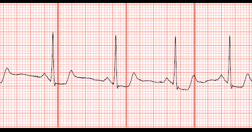 Float Nurse: Practice EKG Strips