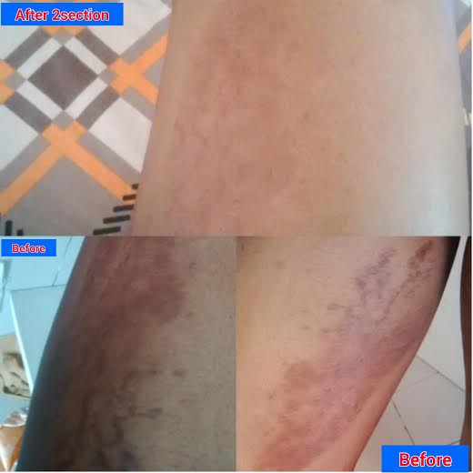 Liposuction, Stretch marks, Gluthathione, Botox, Derma Filer, Hair loss ...