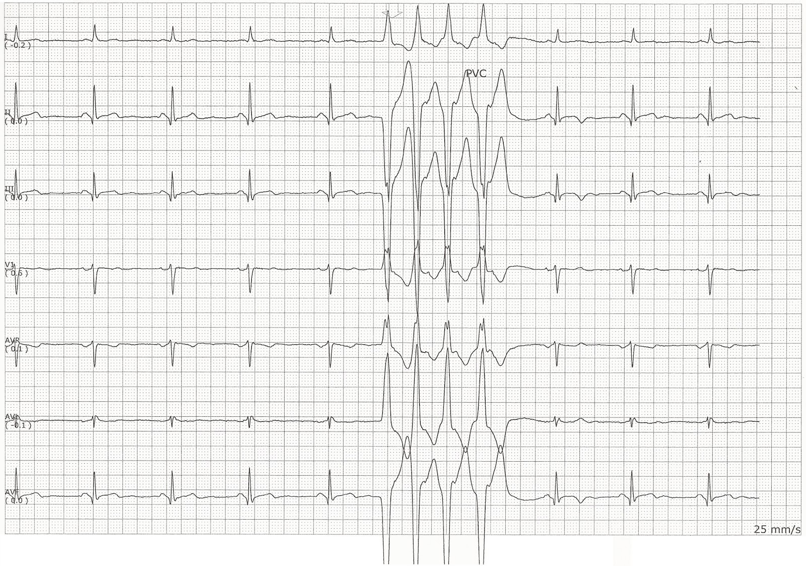 Sinus Bradycardia with a 4 Beat Run of VT