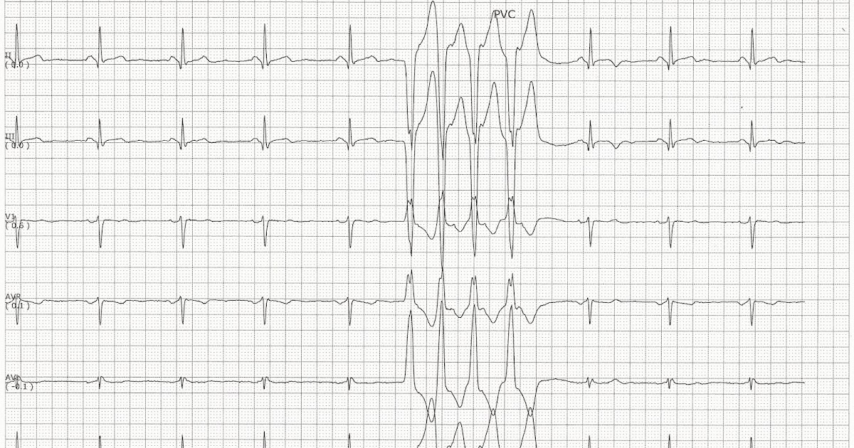Sinus Bradycardia with a 4 Beat Run of VT