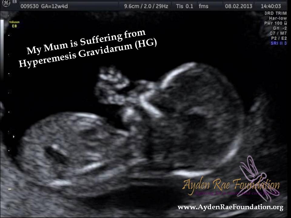 Ayden Rae Foundation: Hyperemesis Gravidarum Awareness