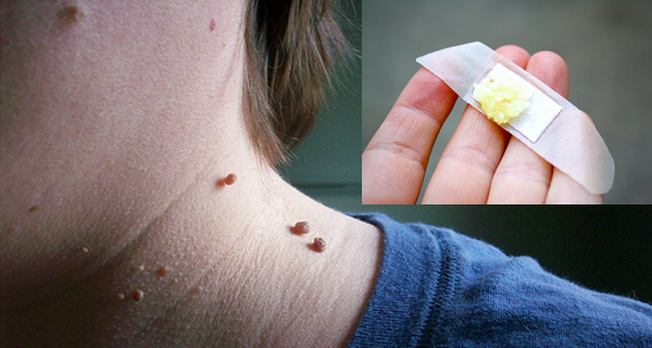 How to Get Rid of Small Warts Using Only One Ingredient - The Central ...