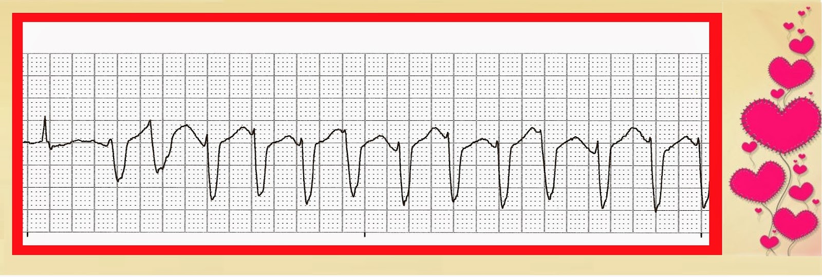Difference Between Monomorphic And Polymorphic Ventricular Tachycardia
