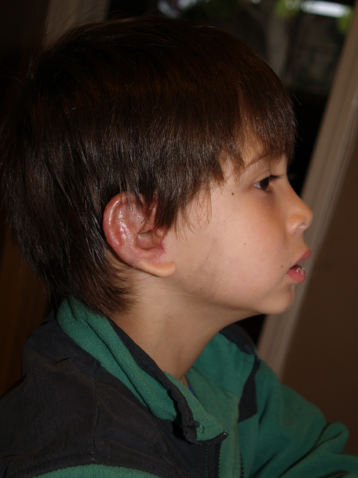 Microtia and Aural Atresia - Our Experience: Two Months Post Microtia ...
