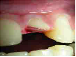 Crown Fractures - Endodontics and Oral Implantology