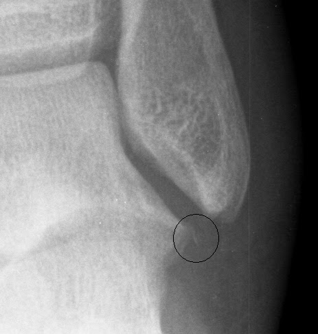Avulsion fracture of the talar attachment of the anterior talofibular ...