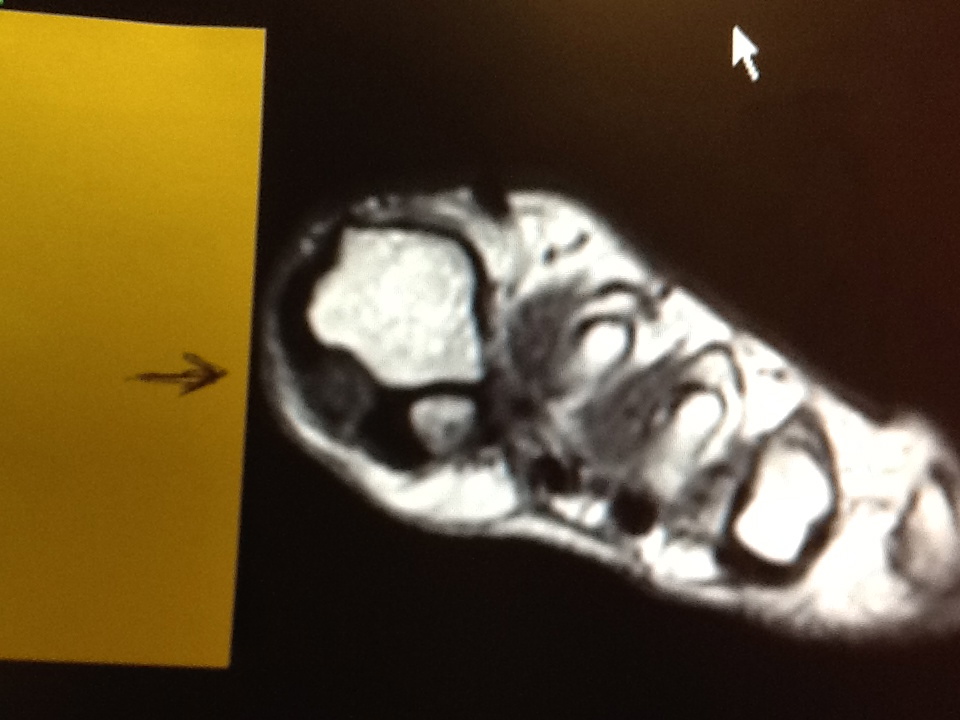 Foot and Ankle Problems By Dr. Richard Blake: Sesamoid Fracture Advice ...
