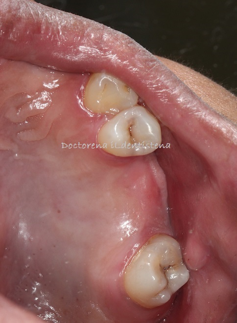 My Dental Diary: Comprehensive case 1 - Multiple edentulous areas
