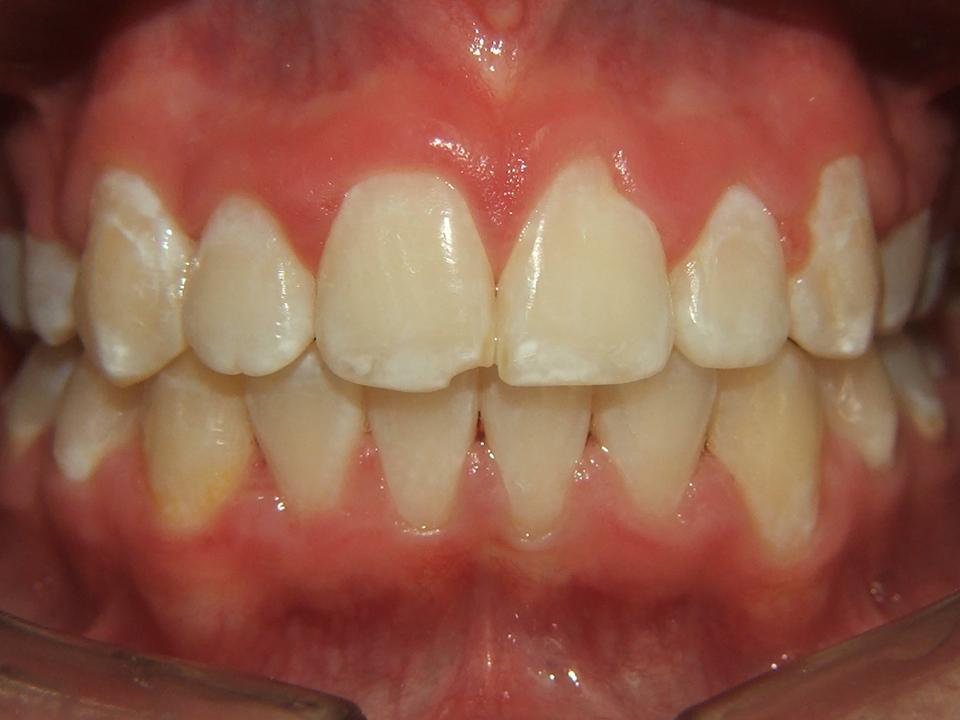 Dr. Miguel Angel Marroquin: EXTRACCION DE PREMOLARES SUPERIORES EN ...