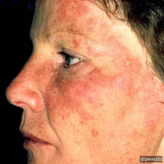 Scarlet Letters, dealing with vascular rosacea, face flushing, burning ...