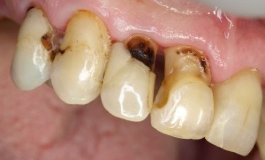 CARIES RADICULAR