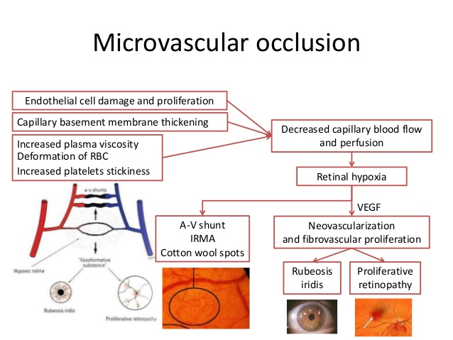 The Health Website : Diabetic Retinopathy