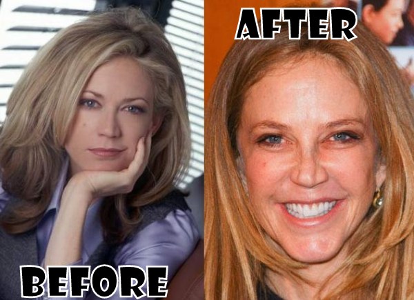 Ally Walker Plastic Surgery Before and After Nose Job and Facelift ...