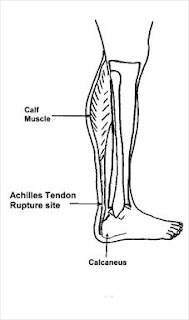 Physics 111: Fundamental Physics I: The Physics of an Achilles Tendon ...