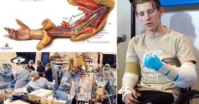 AMAZING STORIES AROUND THE WORLD: Iraq war veteran who lost all four ...