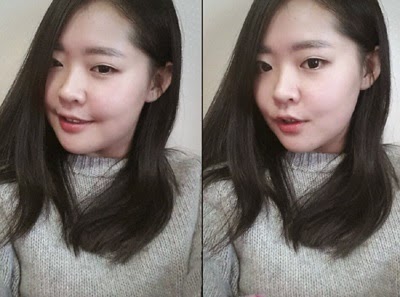 ID Hospital Korea: Before and after underbite jaw surgery at ID ...