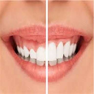 Gingivectomy and Gingivoplasty