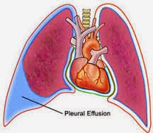 NCP for Disturbed Sleep Pattern related to Pleural Effusion | NCP Blog