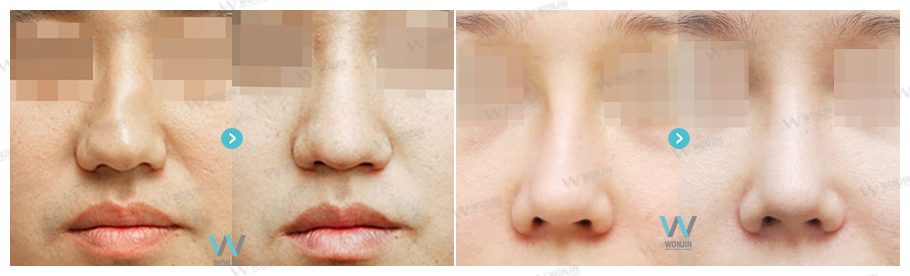 Operasi Plastik Hidung Dengan Tulang Rawan Rusuk