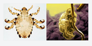 Emfermedades de Transmisiòn Sexual: ¿Que son las ladillas?