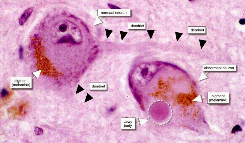 Biology behind: Dementia. - Science in the City