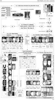 Pedi cardiology: How to identify pacemaker?