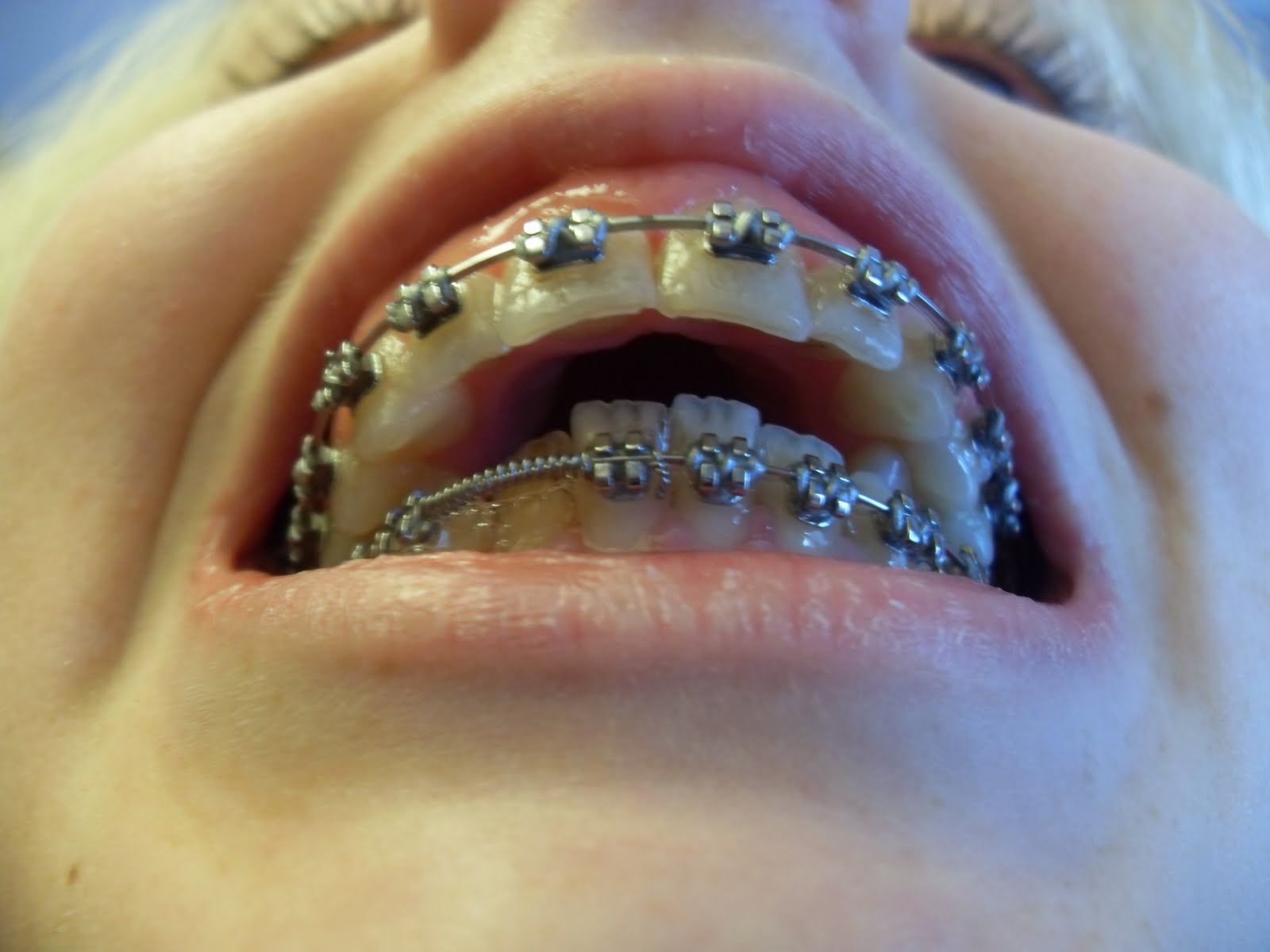 My Jaw Surgery Story: 6 months of braces and appointment update