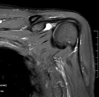 Subcoracoid-Subscapularis Bursa MRI - Sumer's Radiology Blog