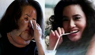 The dailyextracts: Ex-model Disfigured by Cooking Oil Injections