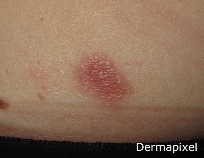 Dermapixel: noviembre 2017