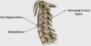 Cervical Osteoarthritis
