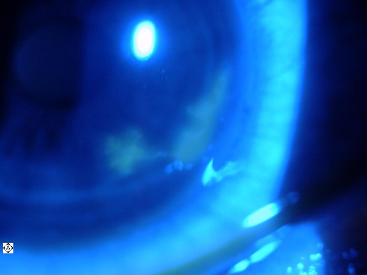 Sonoran Desert Eye Center: HERPES SIMPLEX KERATITIS