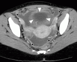 Tuberculous Peritonitis causes , clinical picture , investigations and ...