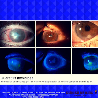 Clínica de Ojos Oftalmic Láser: QUERATITIS INFECCIOSA