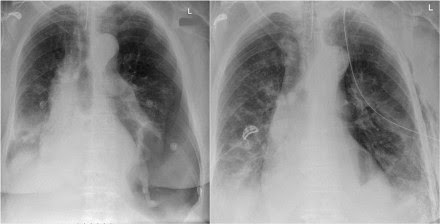 Chest Medicine Made Easy-Dr Deepu: Basics Of Chest X Ray Part-6, The ...