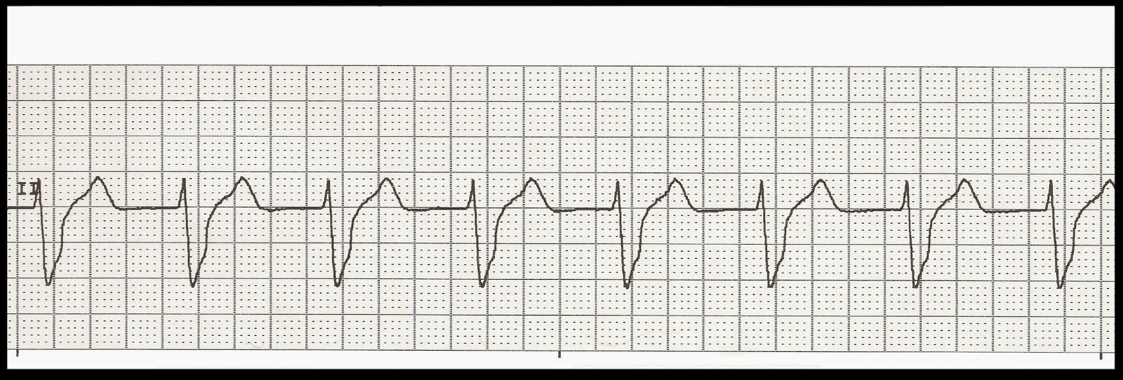 EKG Rhythm Quiz 278: Ventricular Rhythms