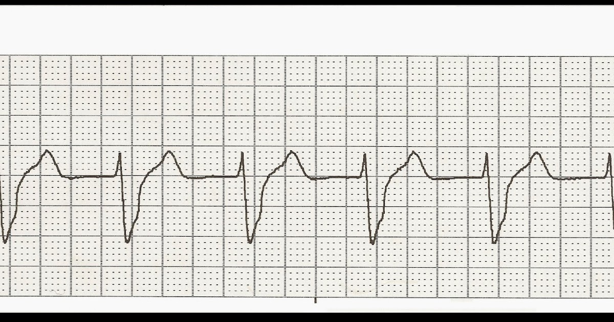 Float Nurse: EKG Rhythm Quiz 278: Ventricular Rhythms