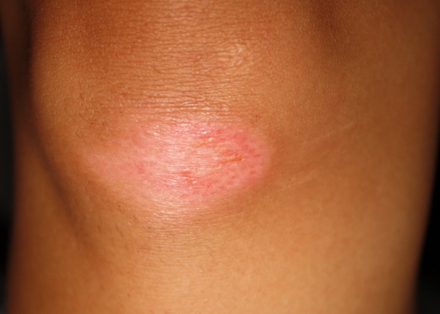 racheena: Five Minute Medical: Friction Burns 101