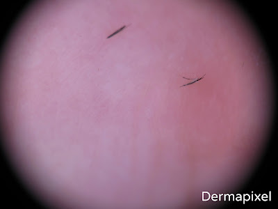 Dermapixel: junio 2017