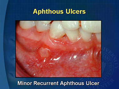 Discovering Aphthous Stomatitis