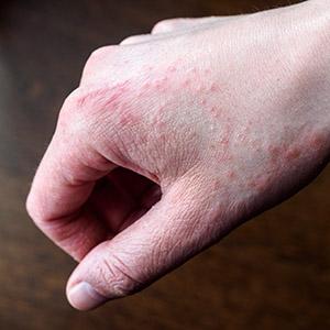 DERMATITE O ECZEMA DELLA MANO: CAUSE E TRATTAMENTO ~ Io Critico