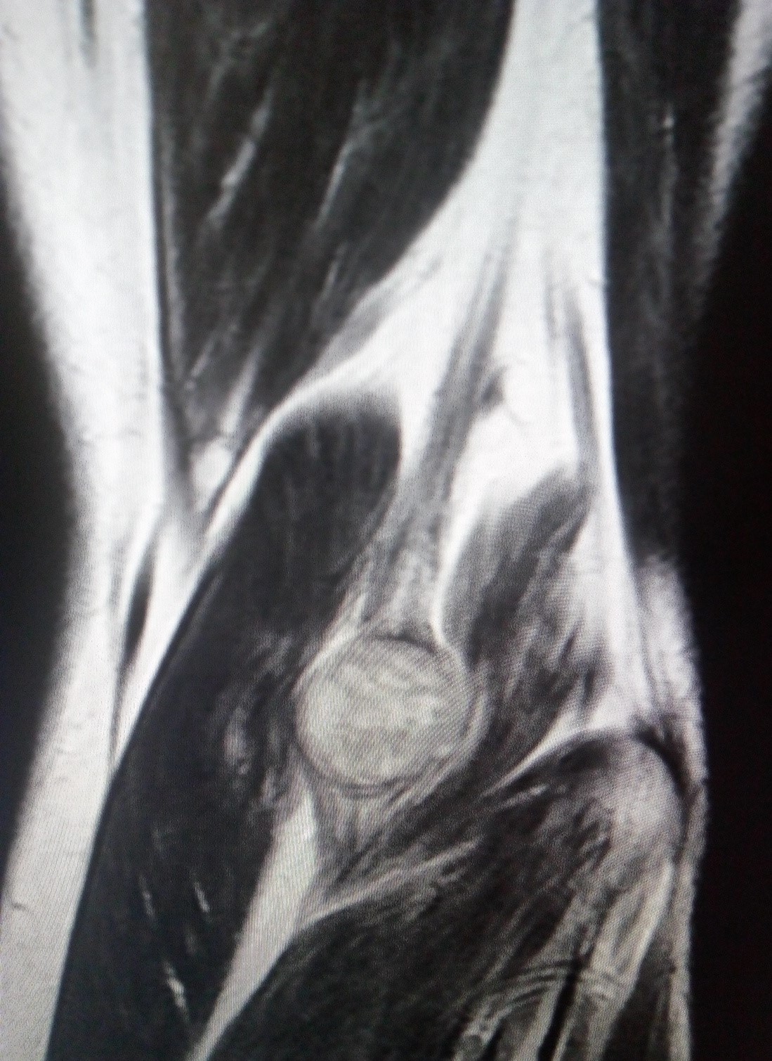 Neurogenic tumor: Teaching Points - Sumer's Radiology Blog