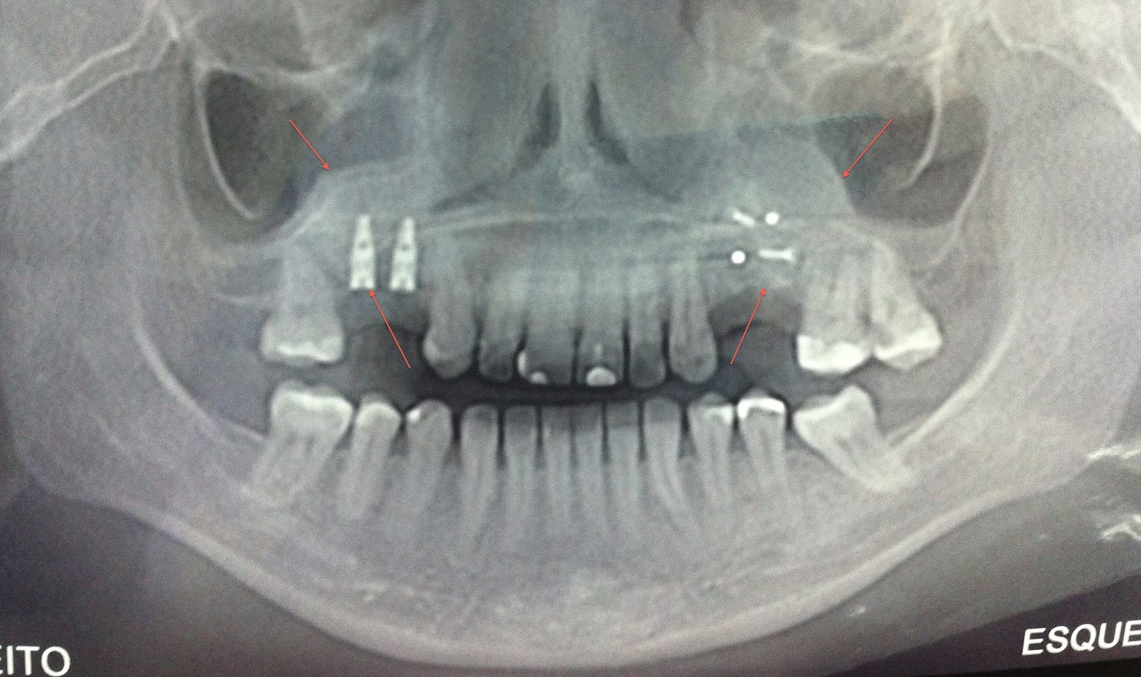 DRA ROSANA: Cirurgia de Elevação do Seio Maxilar