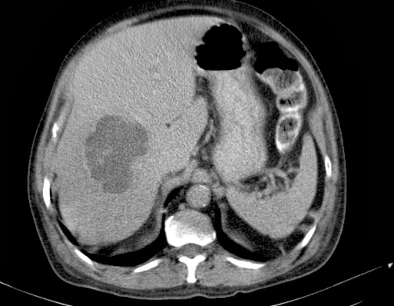 Ultimate Radiology : Case Of Ca Lung