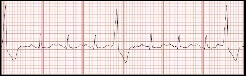 Practice EKG Rhythm Strips 116